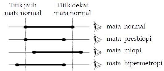 Macam-macam Jenis Cacat Mata