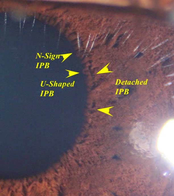 Modern & Multidimensional Iridology: IPB Morphologies - Detached, U & N ...