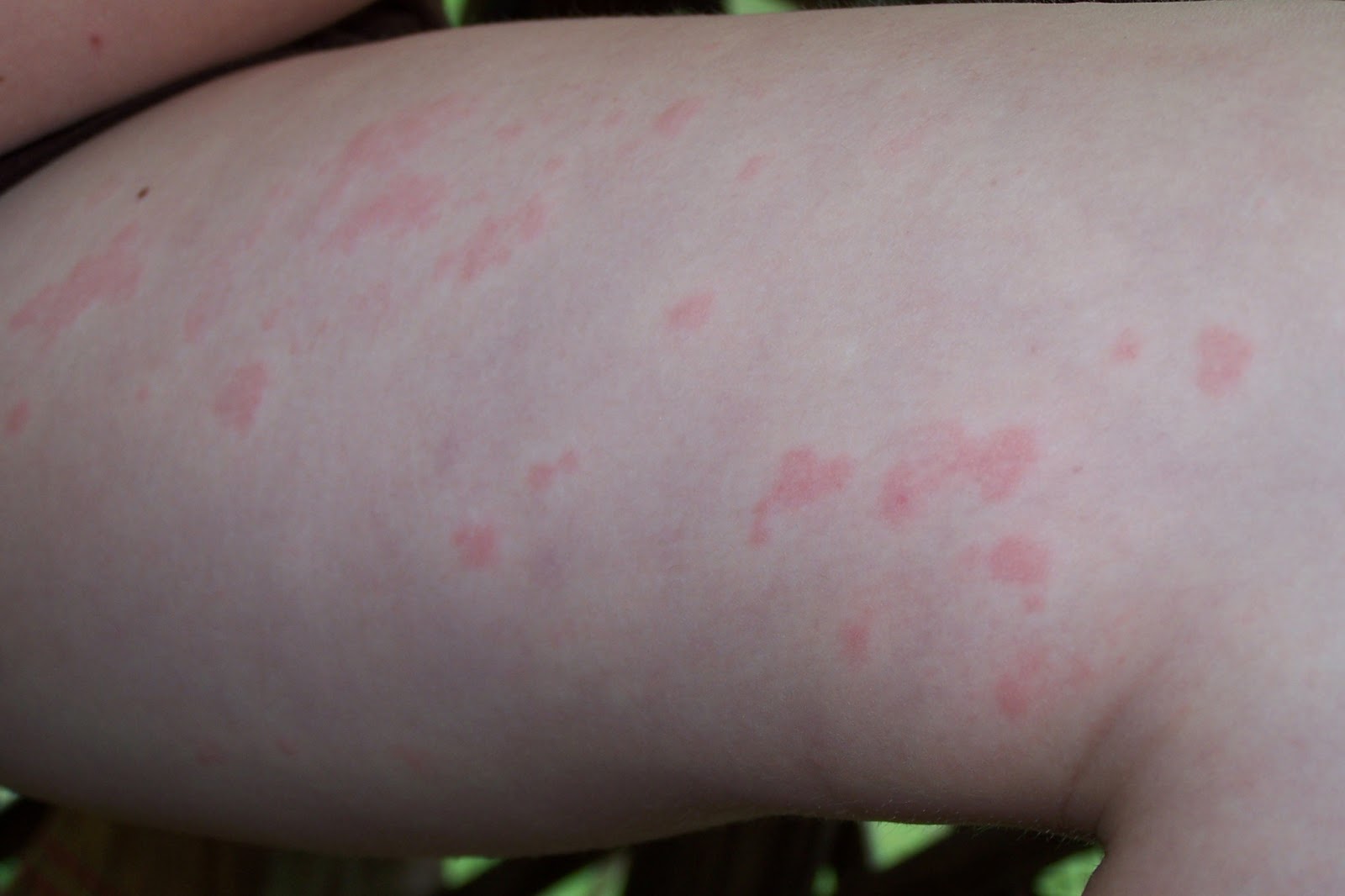 Beyond the Mirror: What Cold Induced Urticaria Looks Like