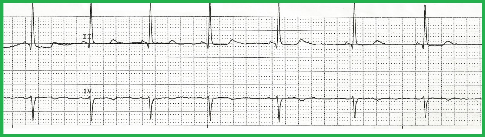 Characteristics of Sinus Rhythms
