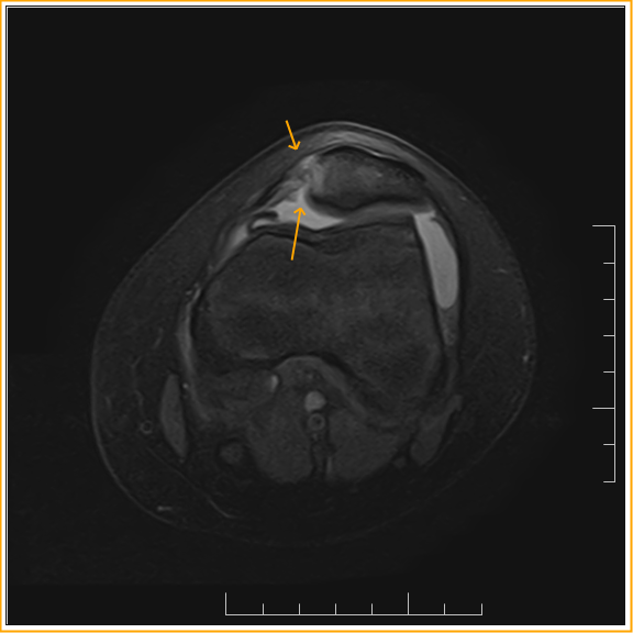 Lateral patellar dislocation - Sumer's Radiology Blog