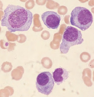 Doença de Crohn: novas perspectivas: Neoplasias de plasmócitos