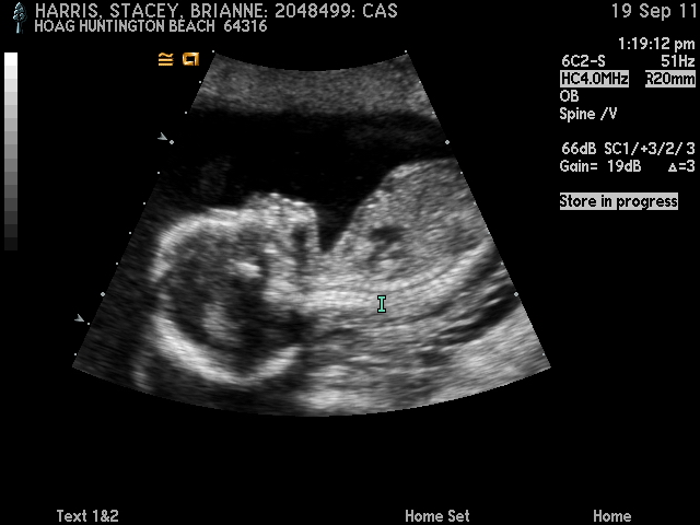 .: 2nd Trimester Ultrasound