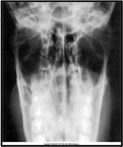 Royal Glamour Radiologi: Temporo Mandibular Joint (TMJ)