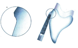 diferença de chanfro largo e chanfro simples - Prótese Fixa