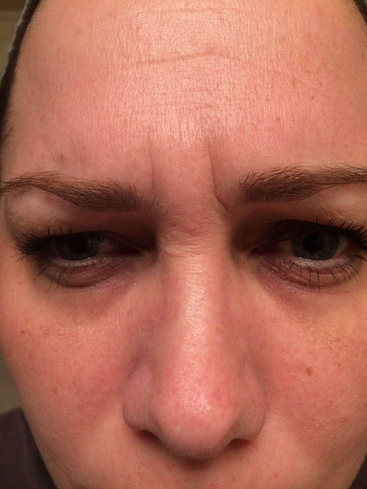 a Mom Looks at 40: So, about that Botox.