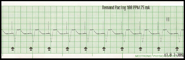 Float Nurse: Unstable Bradycardia Part 3