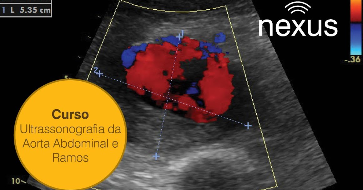 Nexus Escola de Ultrassonografia: Ultrassonografia da Aorta Abdominal e ...