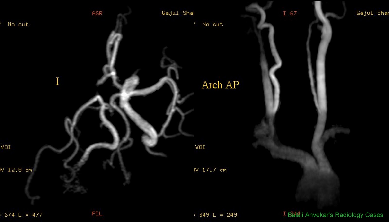 Dr Balaji Anvekar FRCR: Insular ribbon sign in Acute Ischemia