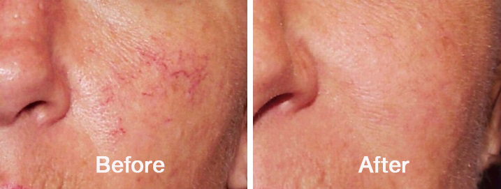 "Quadro Star Pro Yellow Laser" คืออะไร