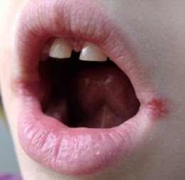 ¿Cómo elegir el mejor tratamiento para Queilitis angular?