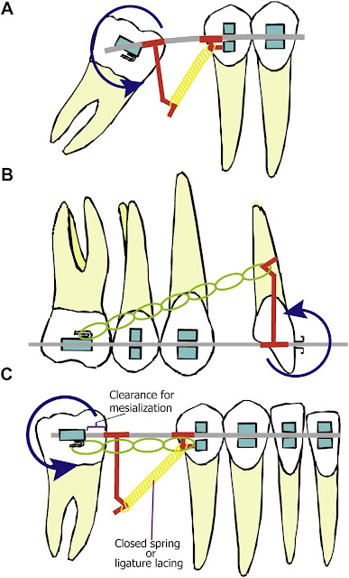 New orthodontic force system..! - Dr. Răng Hàm Nhỏ