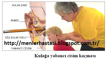 MENİER SENDROMU: Kulak Hastalıkları Resimleri