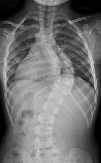 Shilla Growth Guidance Procedure | Growing Spine Blog | Washington ...