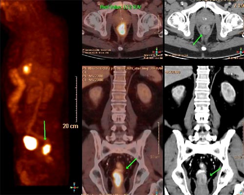 LA PET PARA EL DIAGNÓSTICO Y ÓPTIMO TRATAMIENTO DEL CÁNCER DE COLON: LA ...