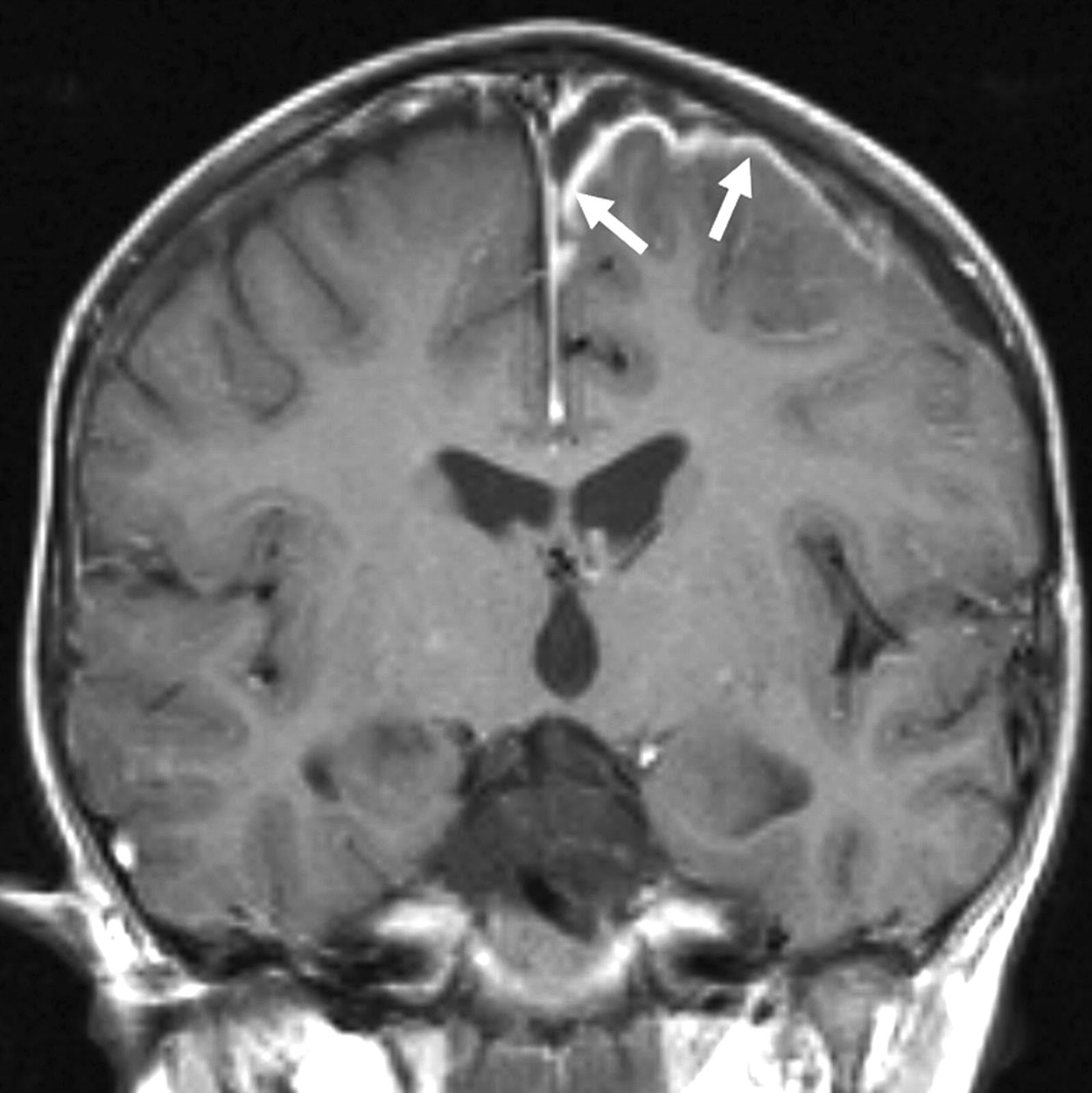 Brain and Spines: Meningitis