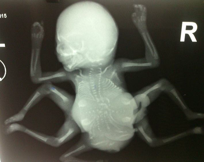 Dr Rajshree Katke (Nee Sonkawde): A rare presentation of heteropagus ...