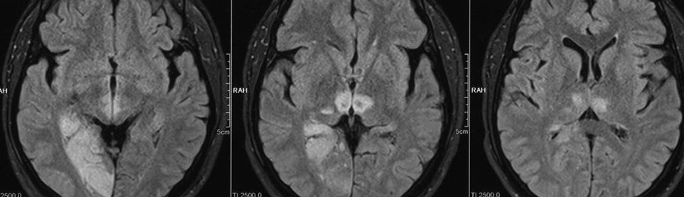 Artery of Percheron Infarction: MRI - Sumer's Radiology Blog