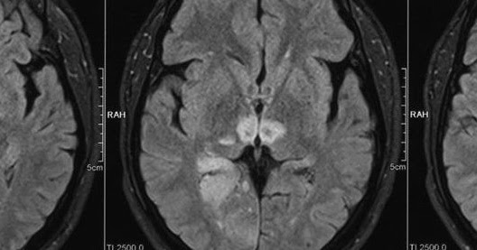Artery of Percheron Infarction: MRI - Sumer's Radiology Blog