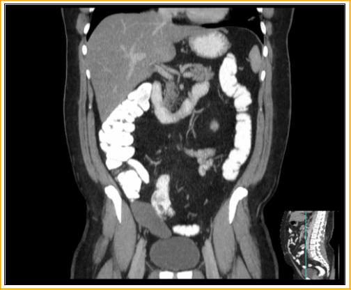 Appendiceal Mucocele: CT - Sumer's Radiology Blog