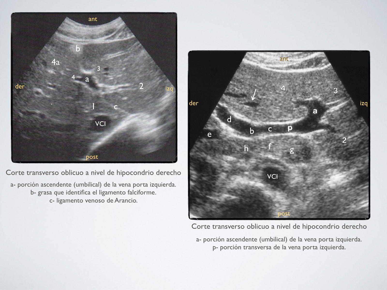 Cuadernos de Anatomía Quirúrgica: Segmentación hepática en ecografía.