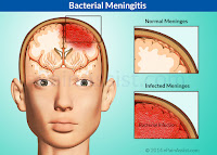 Nursing Care Plan for Meningitis - Nursing Care Plan
