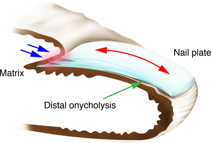 Centre Podoclínic: INFLAMACIÓ I DOLOR MOLT FORT EN LA CUTÍCULA DE L ...