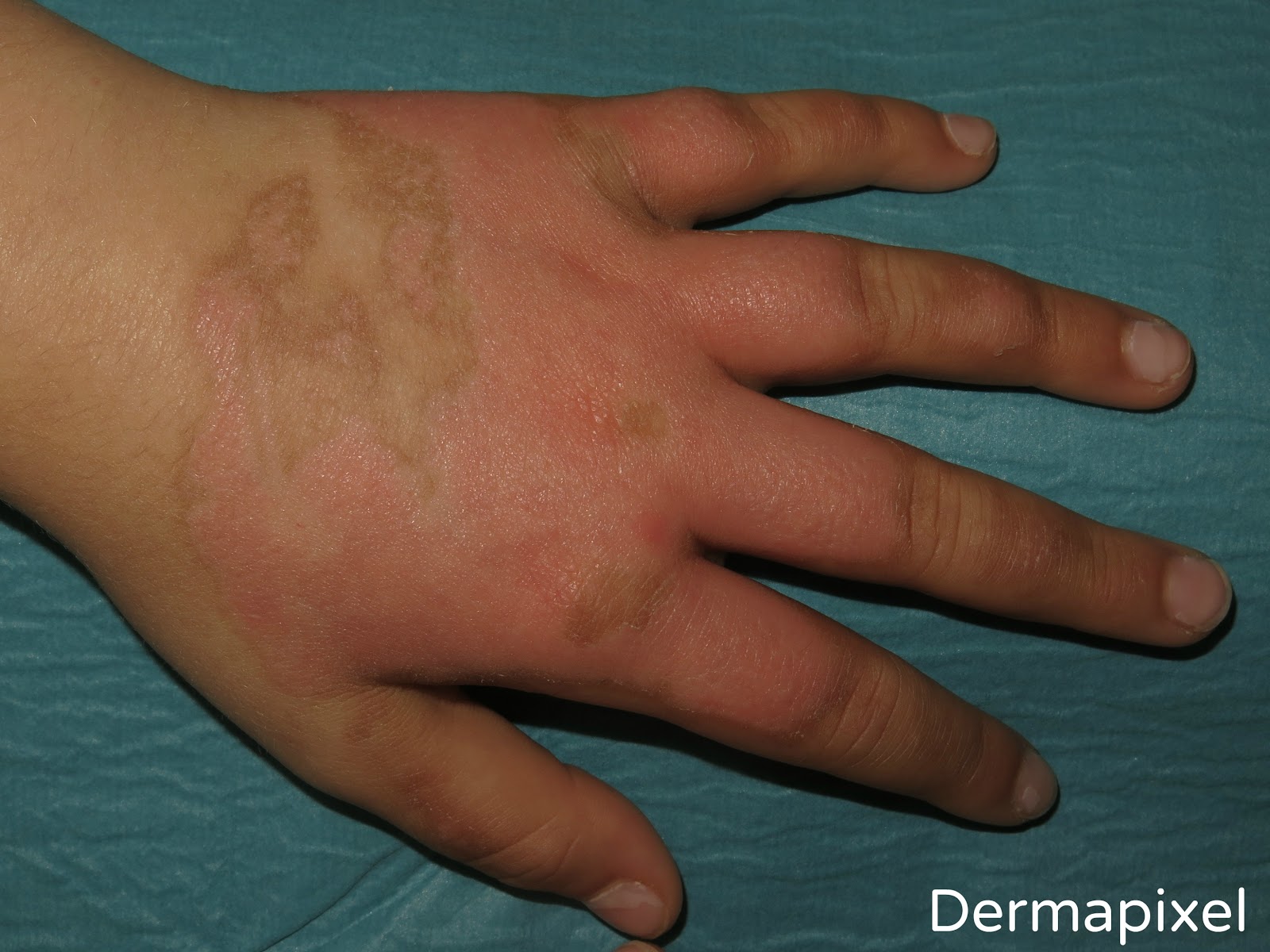 Dermapixel: julio 2017