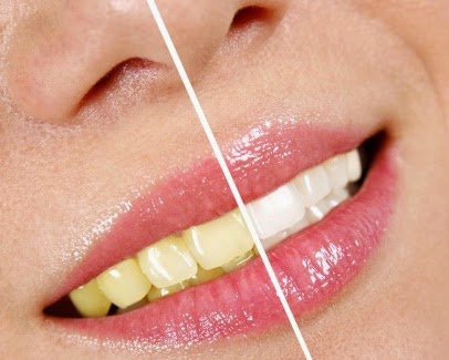 Oroville Gentle Dentistry: Why Are My Teeth Yellow?