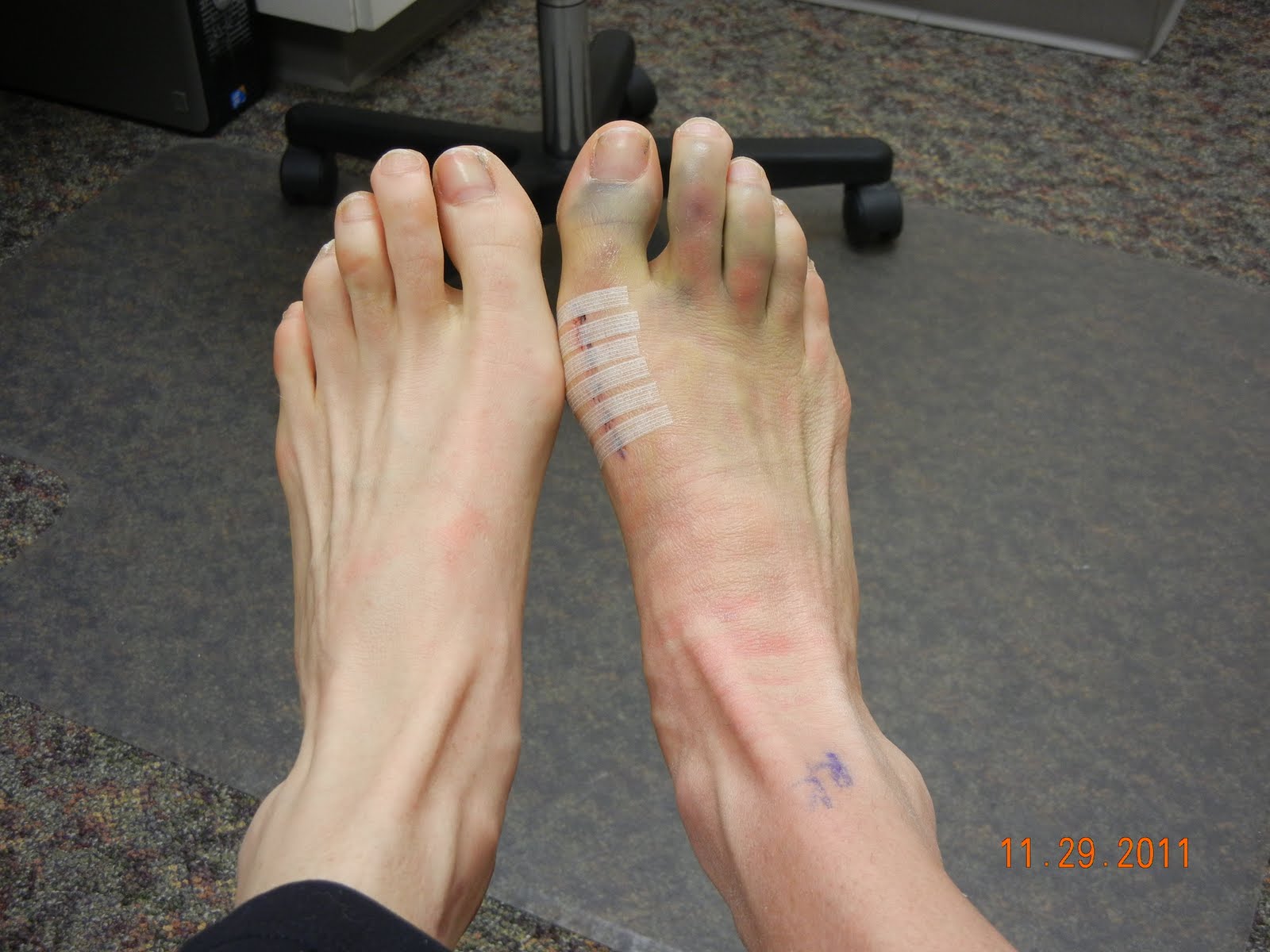 Downs Bunion Surgery 11.17.2011 Hallux Valgus Deformity with Metatarsal ...