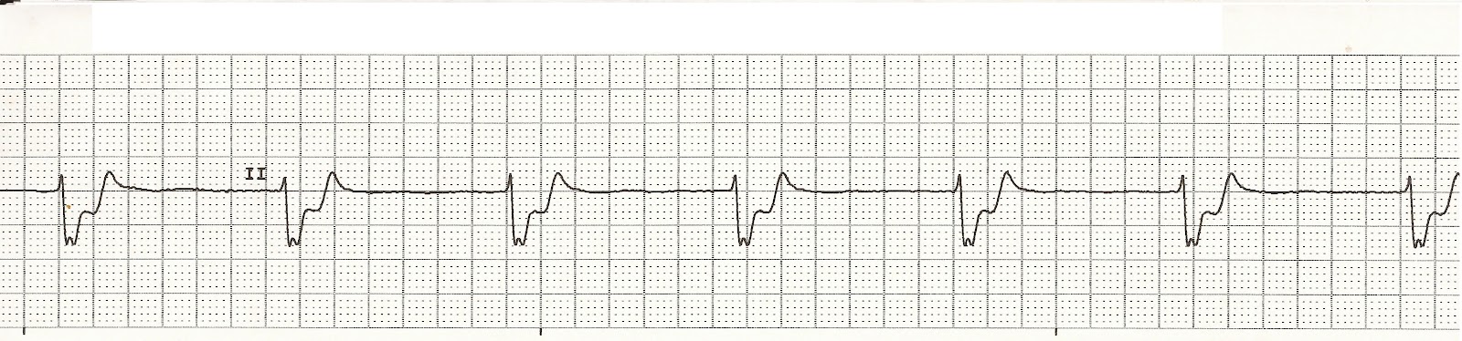 EKG Rhythm Strip Quiz 55: Ventricular Rhythms