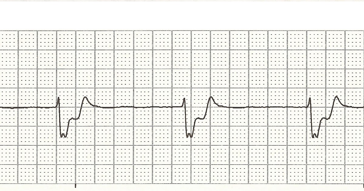 EKG Rhythm Strip Quiz 55: Ventricular Rhythms