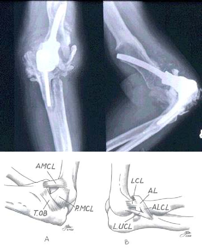 Biomecanica del MMSS: Biomecanica y anatomía funcional del codo.