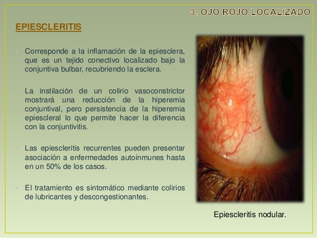 Clínicaibm.com: Diferencia entre la Episcleritis y la Escleritis
