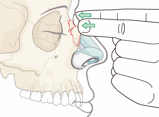 Nasal Fractures - Causes, Symptoms, Diagnosis, Treatment