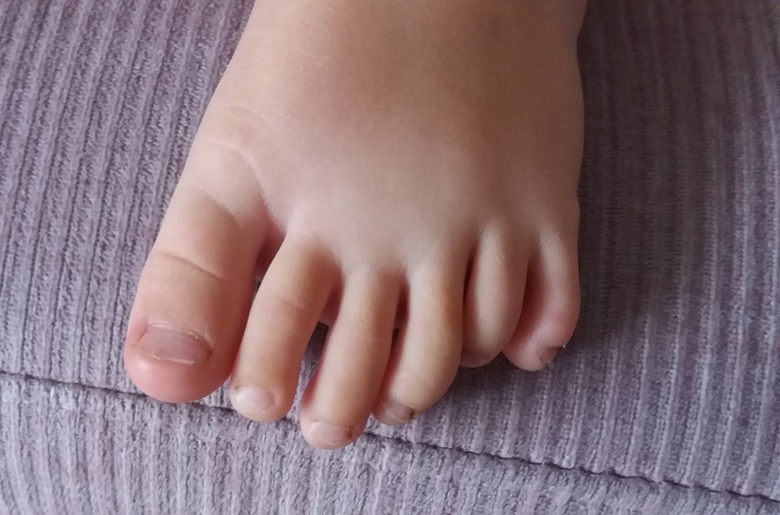 Tenen en hun verhaal - #365tenen: OPROEP: IS JOUW KIND GEBOREN MET 6 ...