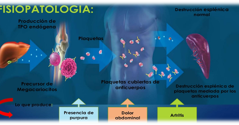 Trombocitopenia inmune