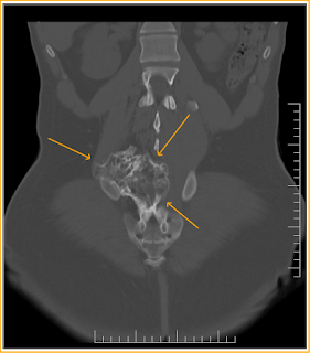 Sacral Osteochondroma-CT - Sumer's Radiology Blog