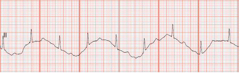 Float Nurse: Basic EKG Test 54
