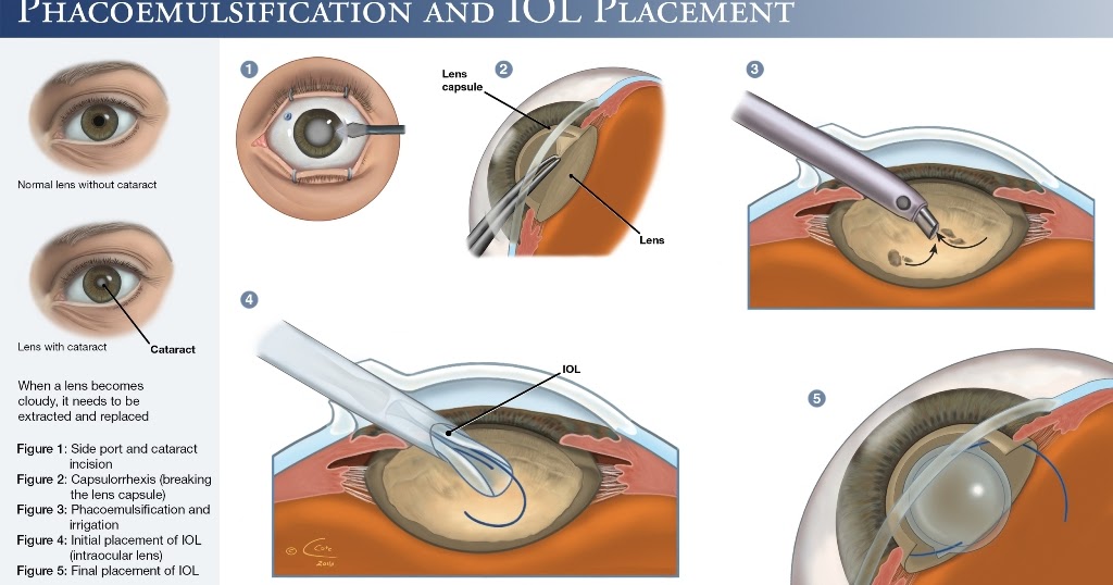 Biomedical Engineering: Very Clear Illustration Regarding Phaco ...