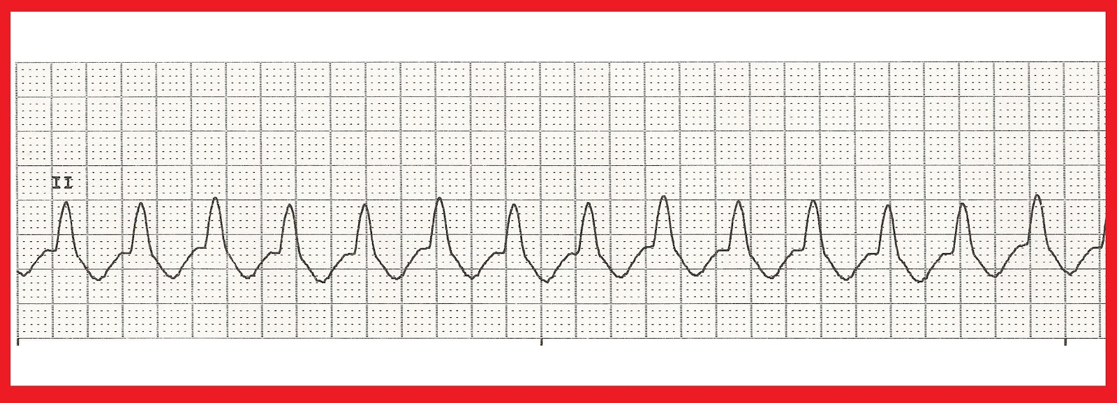 Ventricular rhythm Quiz 294