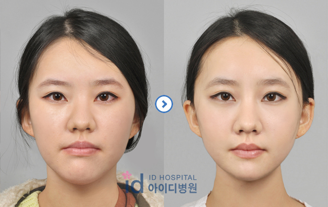 ID Hospital Korea: best plastic surgery hospital in korea, id hospital ...