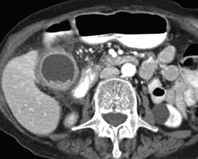 X-RAYview: COLECISTITE