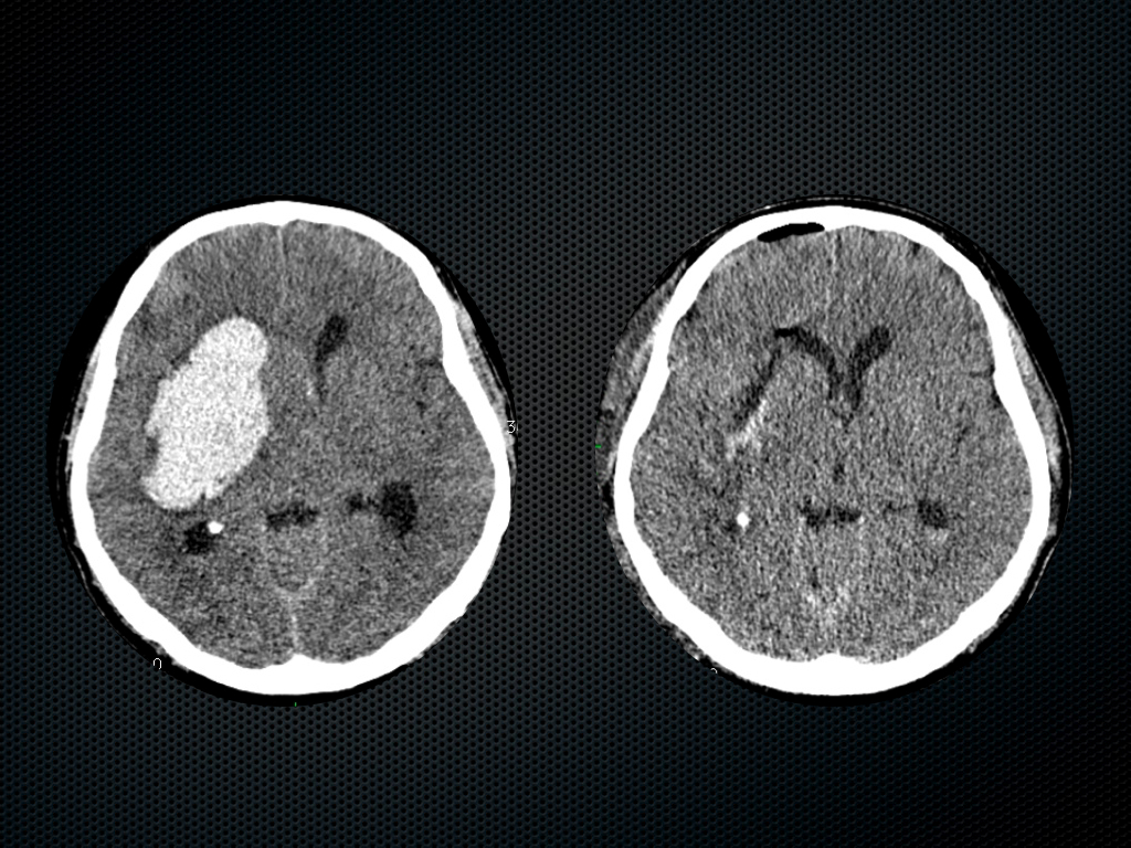 Hemorragia Putaminal; Hemorragia Encefálica Putaminal; Hemorragia del ...