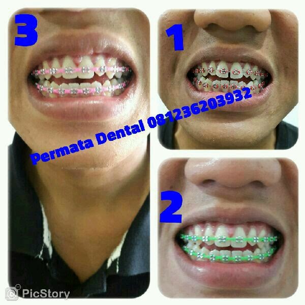 DOKTER GIGI BALI: Pengen Punya Gigi Rapi Dan Ganteng Alasan Pria ini ...