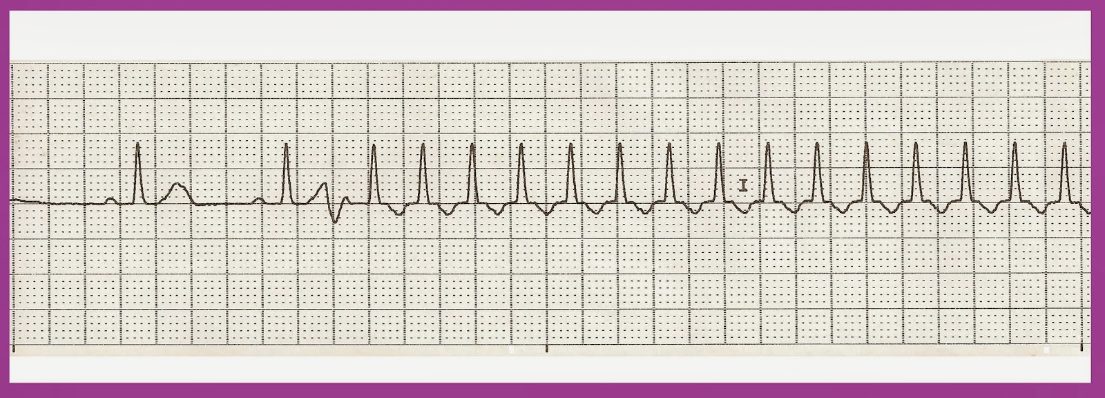 Practice EKG Rhythm Strips 217