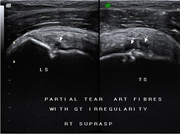 HIGH RESOLUTION SONOGRAPHY IN ROTATOR CUFF TEAR - Sumer's Radiology Blog
