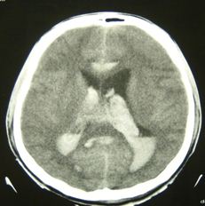 Dr Herry Setya Yudha Utama SpB. FInaCS. MHKes. ICS: Seri Bedah Saraf ...