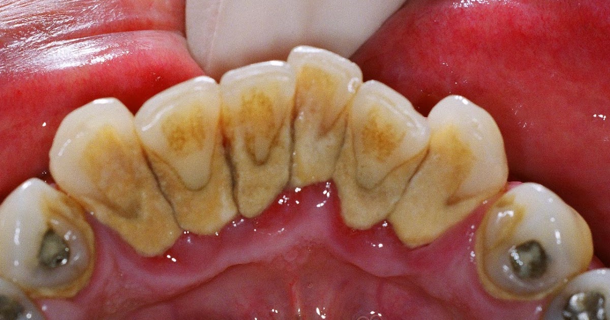 ¿Qué es y cómo se forma el sarro dental? | Odontologia Salud y Hoy!