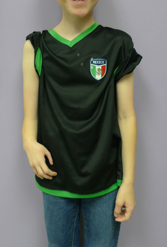 Form and Function in Radial Deficiency | Congenital Hand and Arm ...